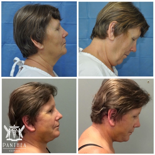 Face Lift (Rhytidectomy) - Plastic Surgery Hub