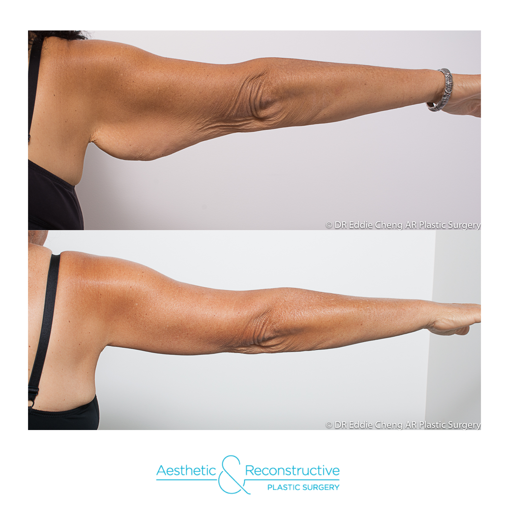 Brachioplasty, or Arm Lift with Dr Eddie Cheng Blog - Plastic Surgery Hub