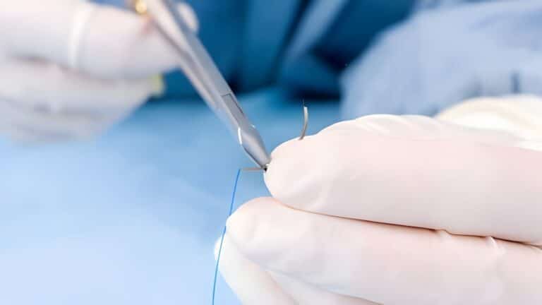 What Does "Spitting Stitches" mean? - Plastic Surgery Hub